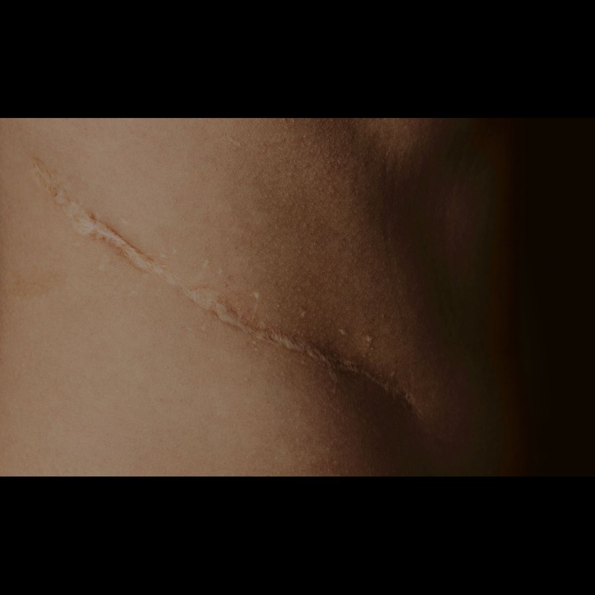 Scar tissue | Bond University | Gold Coast, Queensland, Australia